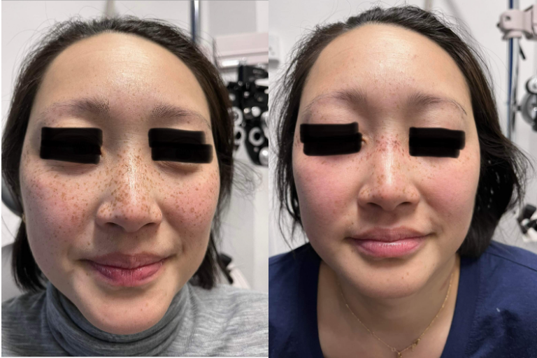 Guide to Intense Pulsed Light & Radiofrequency for Dry Eye