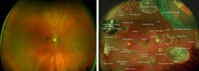 Why Doctors Use Optomap Retinal Imaging | Eye Health