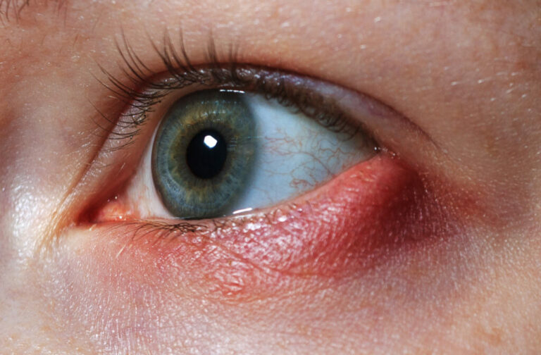What is a Stye and How to Prevent Them | Eye Health